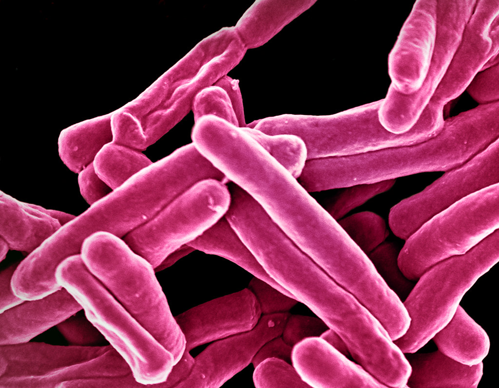 La tuberculosis es aún mortal - Empíreo Diagnóstico Molecular ...